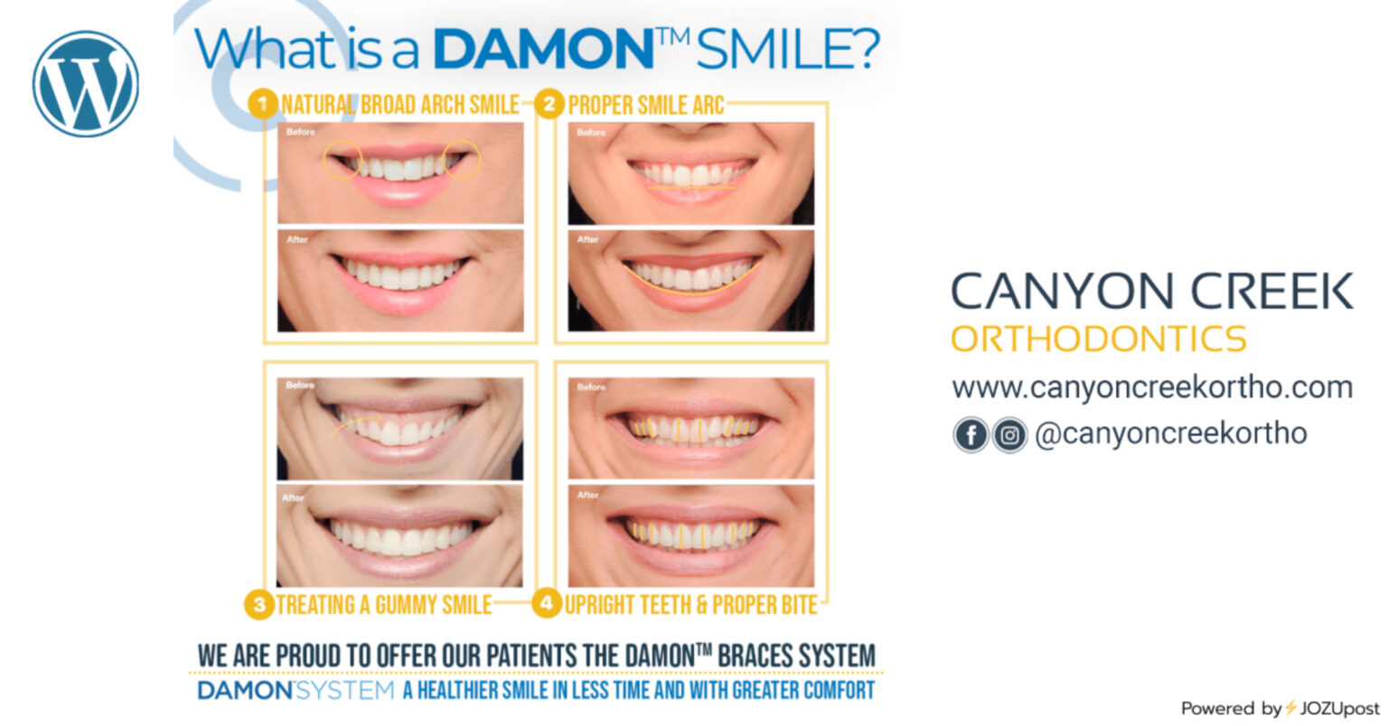 What Is A Damon Smile – Canyon Creek Orthodontics