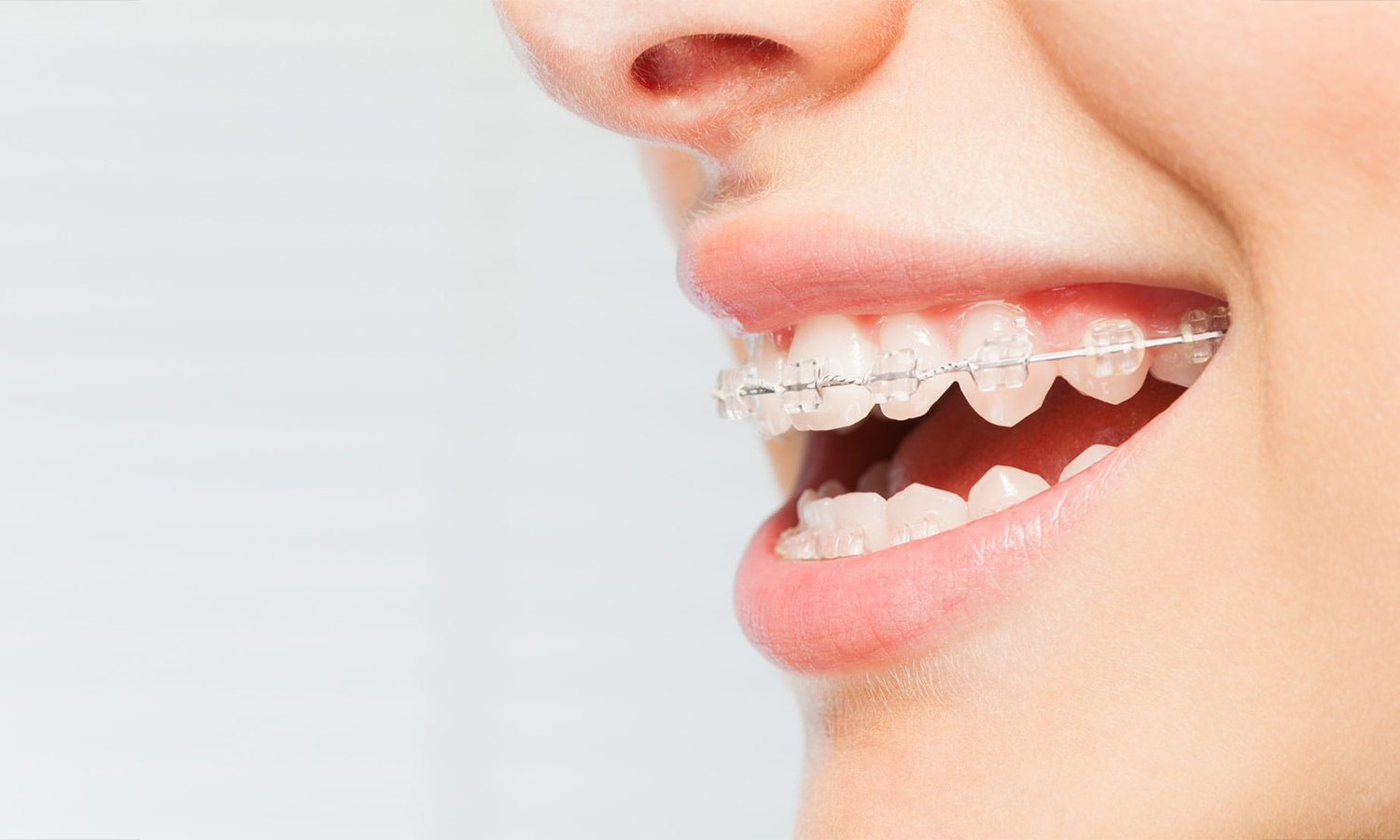 Damon® Clear Braces – Canyon Creek Orthodontics
